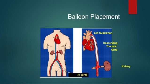 IABP when , why and how