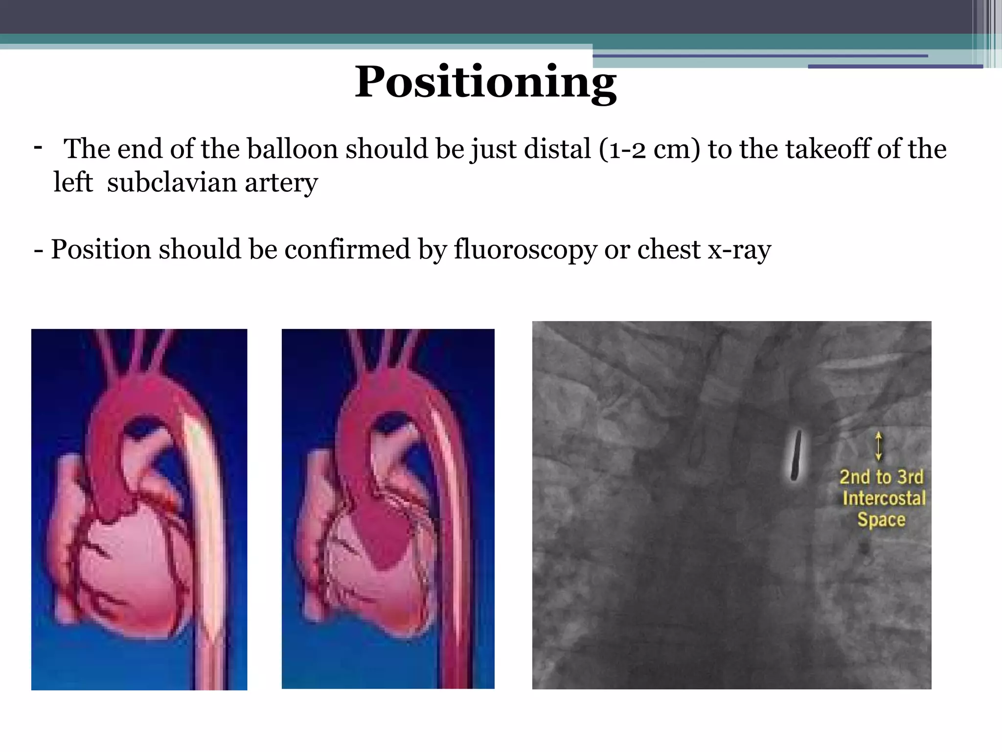 INTRA AORTIC BALLON PUMP (IABP) | PPT