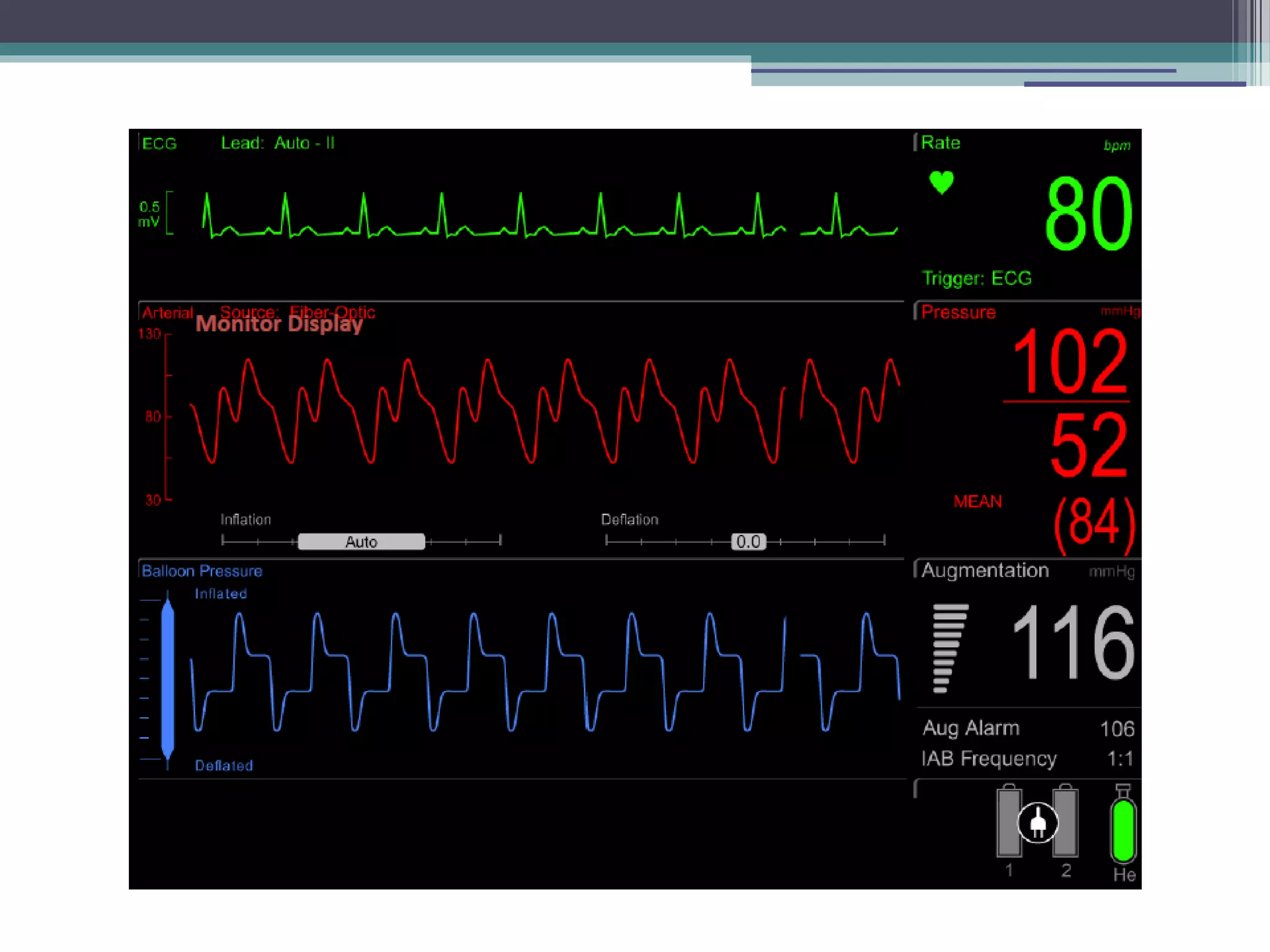 INTRA AORTIC BALLON PUMP (IABP) | PPT