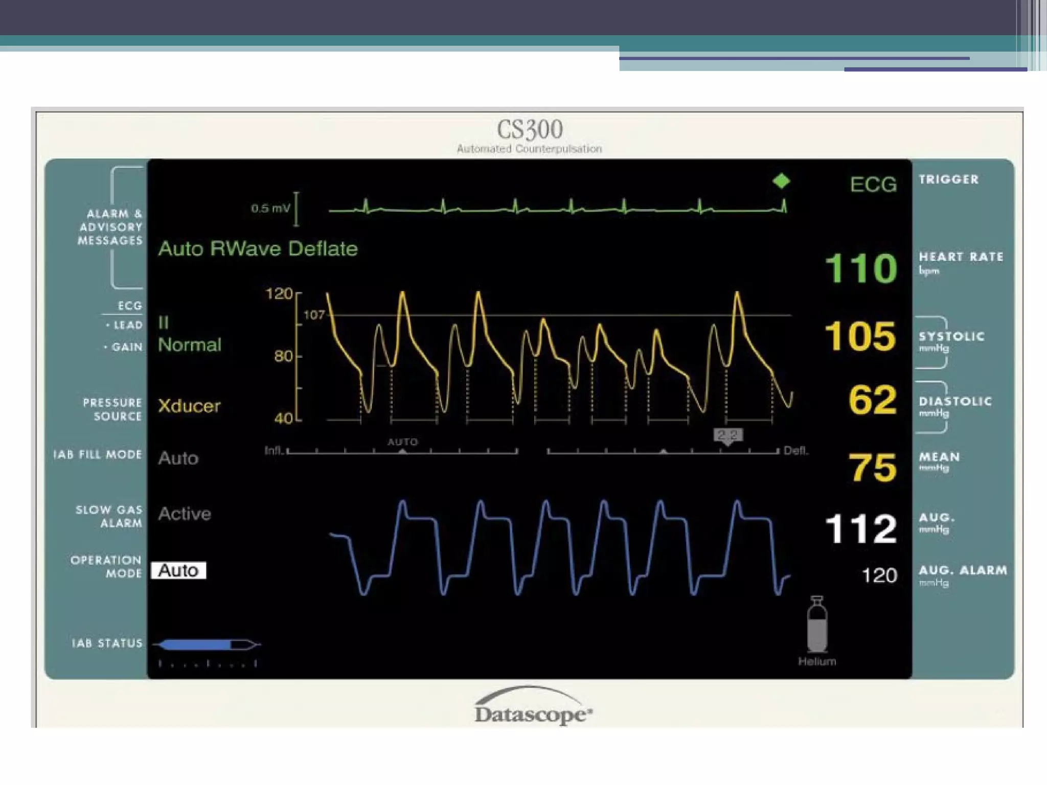 INTRA AORTIC BALLON PUMP (IABP) | PPT
