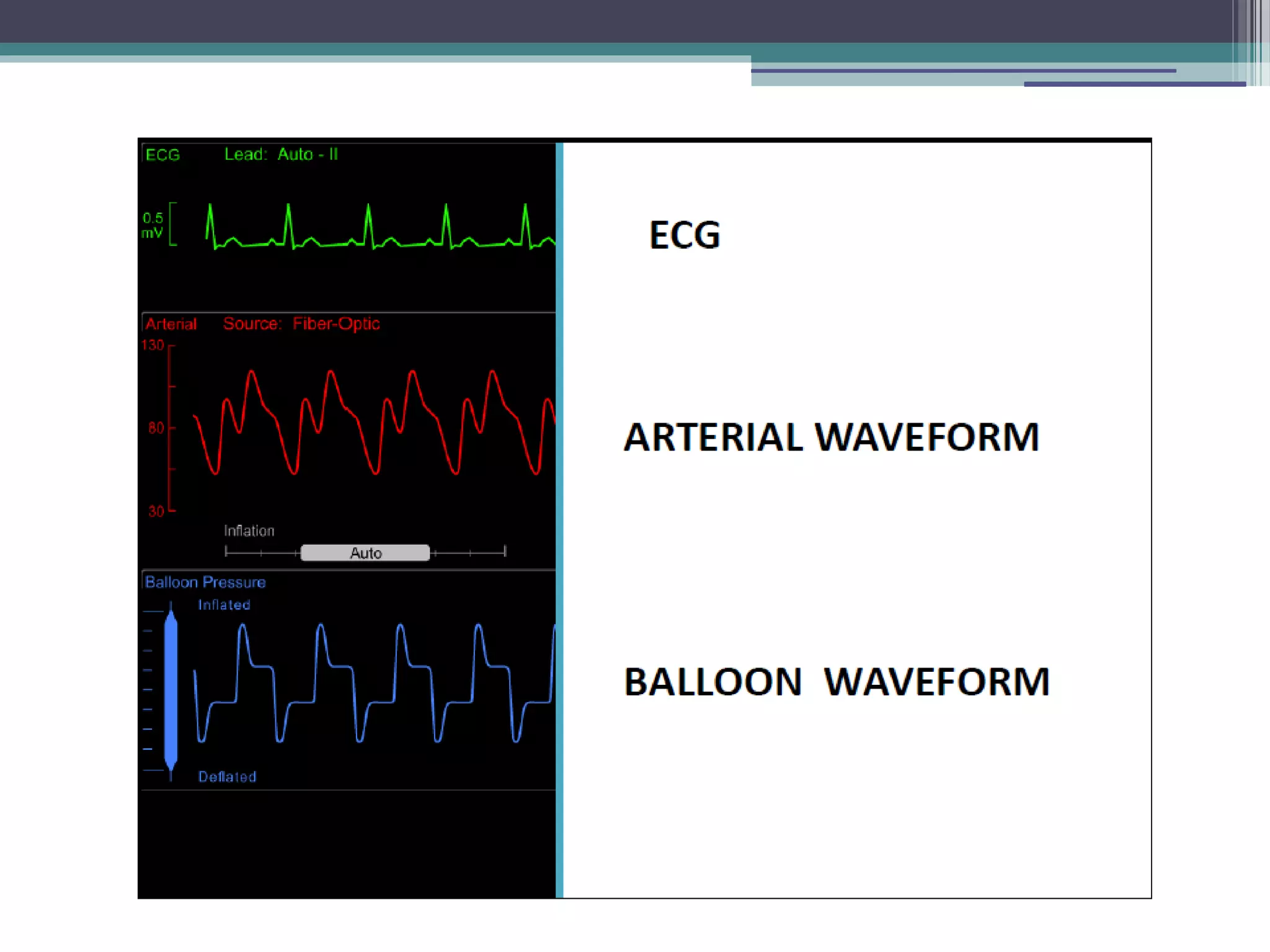 INTRA AORTIC BALLON PUMP (IABP) | PPT