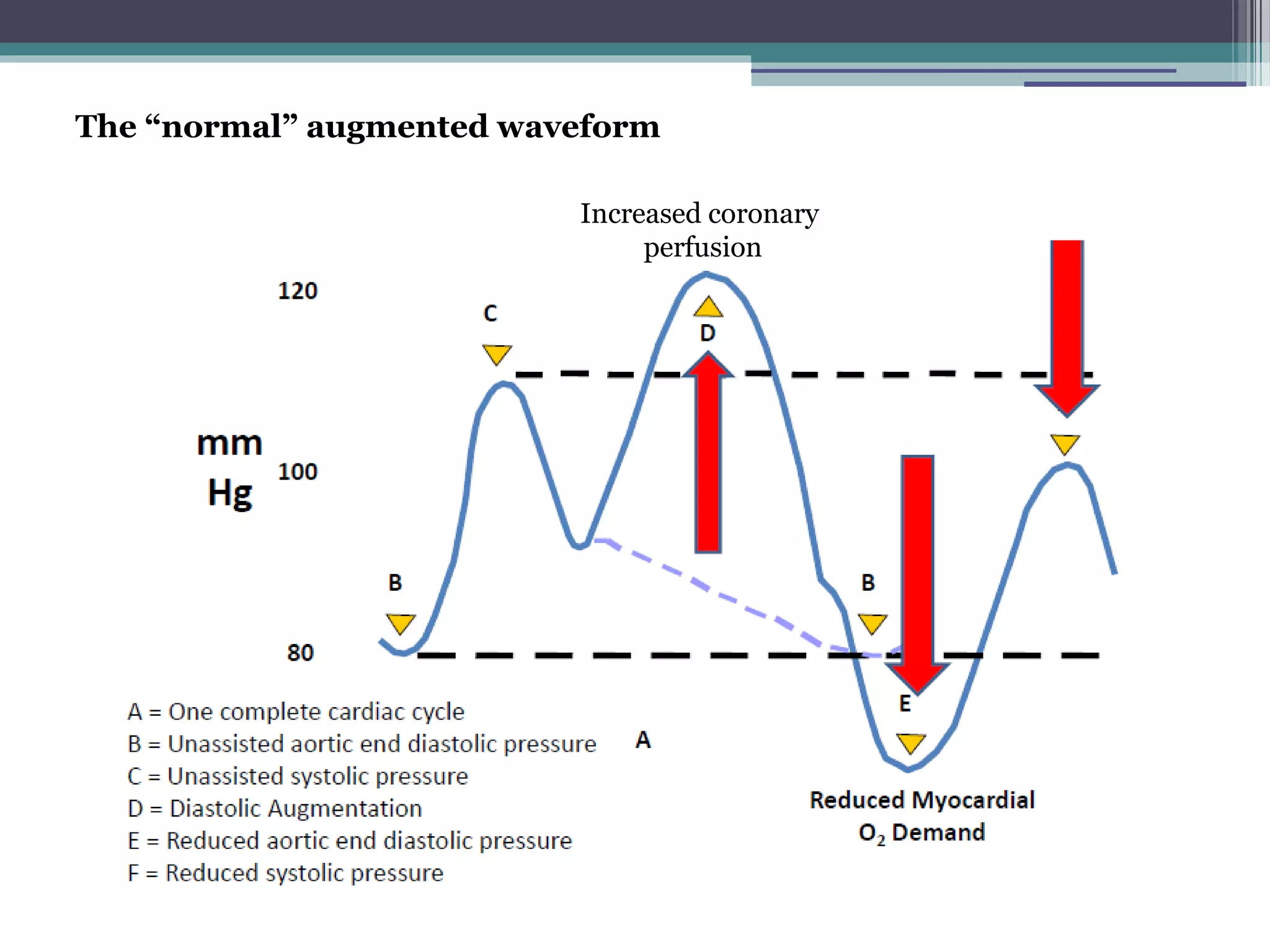 INTRA AORTIC BALLON PUMP (IABP) | PPT
