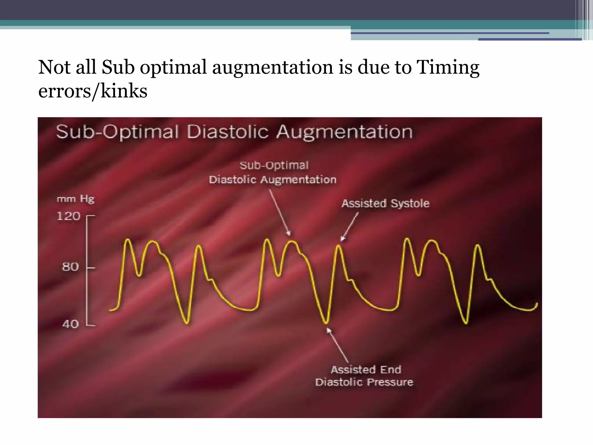 INTRA AORTIC BALLON PUMP (IABP) | PPT
