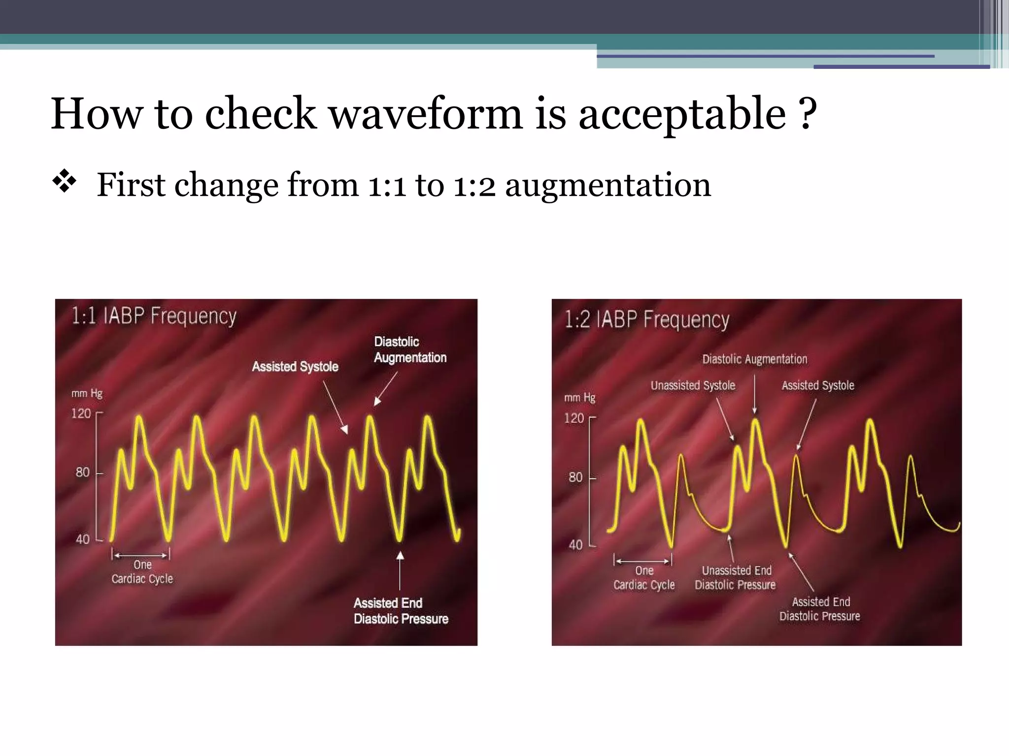 INTRA AORTIC BALLON PUMP (IABP) | PPT