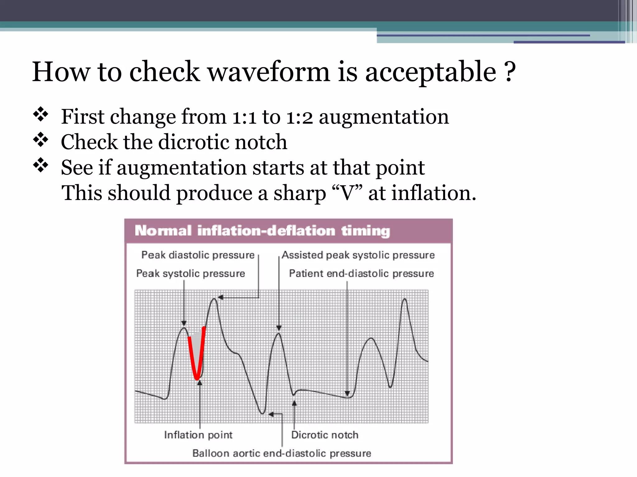 INTRA AORTIC BALLON PUMP (IABP) | PPT