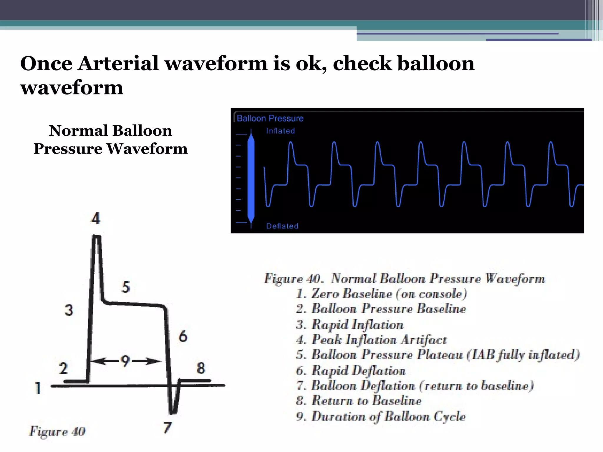 INTRA AORTIC BALLON PUMP (IABP) | PPT
