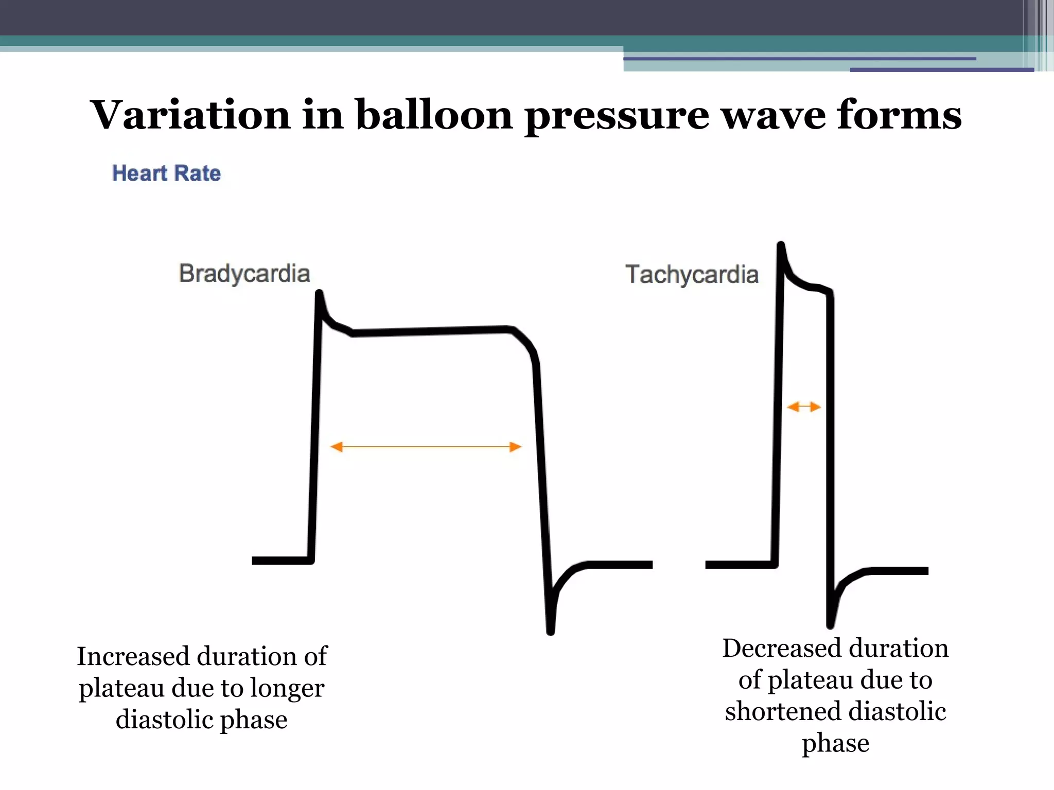 INTRA AORTIC BALLON PUMP (IABP) | PPT