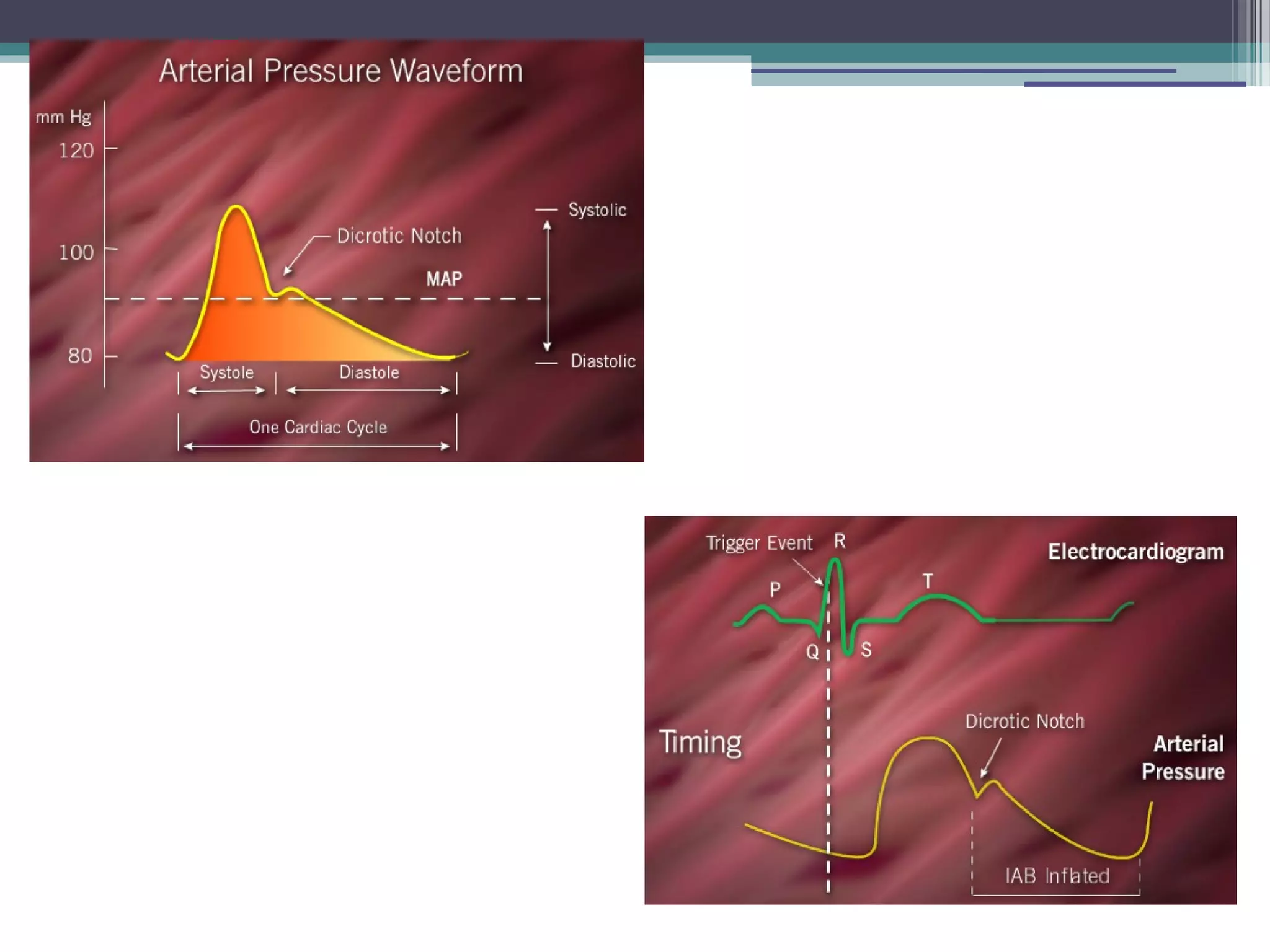 INTRA AORTIC BALLON PUMP (IABP) | PPT