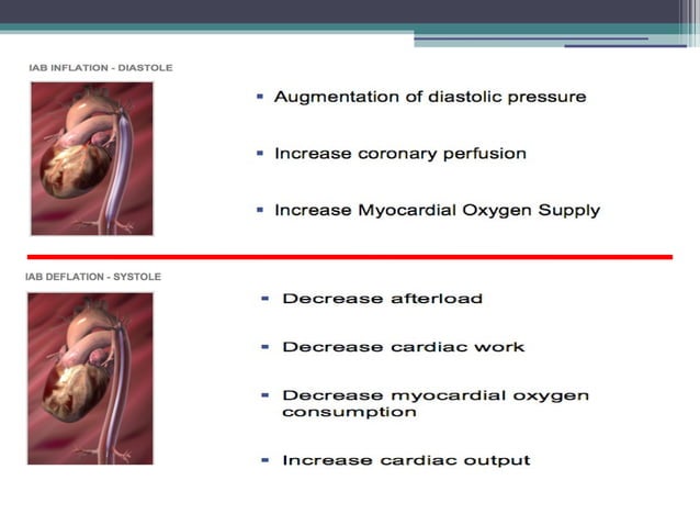 INTRA AORTIC BALLON PUMP (IABP) | PPT