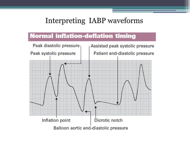 INTRA AORTIC BALLON PUMP (IABP) | PPT