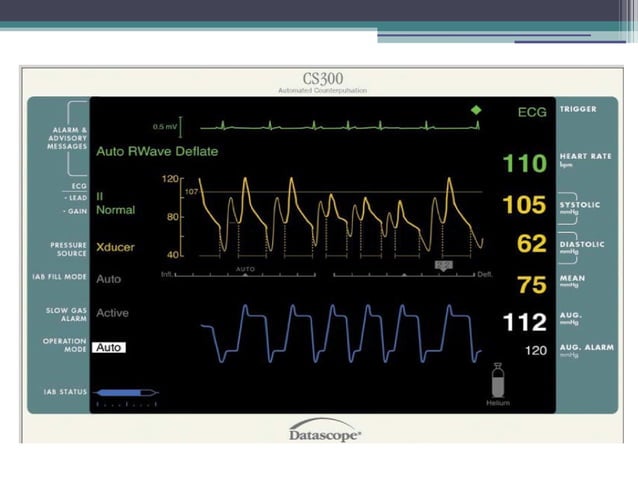 INTRA AORTIC BALLON PUMP (IABP) | PPT
