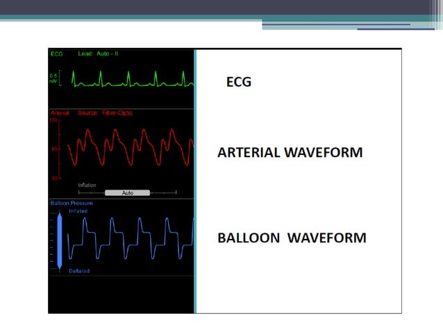 INTRA AORTIC BALLON PUMP (IABP) | PPT