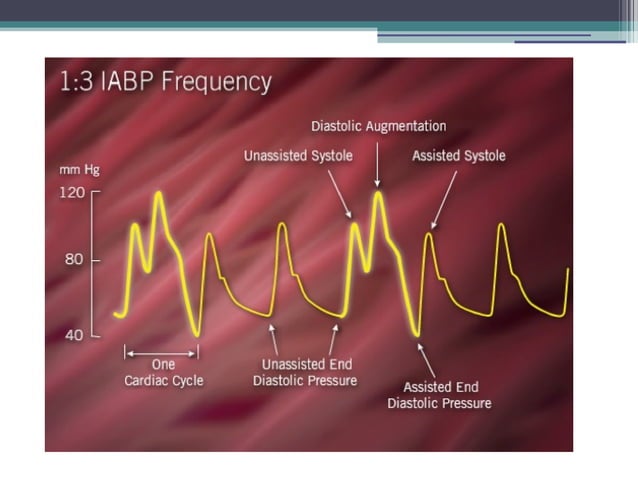 INTRA AORTIC BALLON PUMP (IABP) | PPT