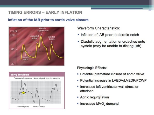INTRA AORTIC BALLON PUMP (IABP) | PPT