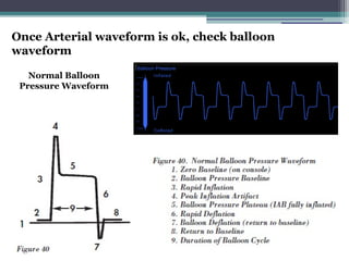 INTRA AORTIC BALLON PUMP (IABP) | PPT