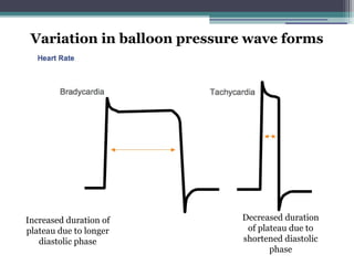 INTRA AORTIC BALLON PUMP (IABP) | PPT