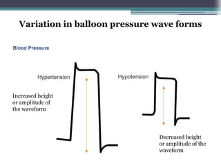 INTRA AORTIC BALLON PUMP (IABP) | PPT