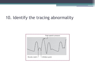 INTRA AORTIC BALLON PUMP (IABP) | PPT