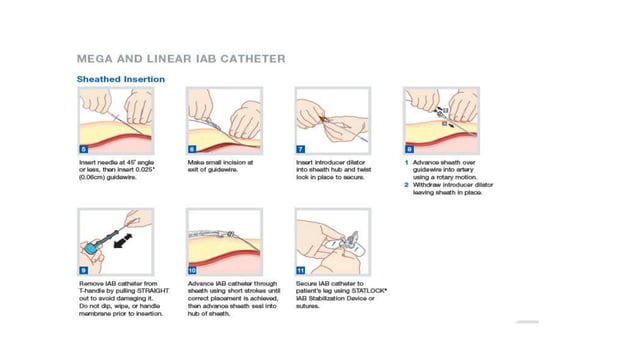 IABP troubleshooting | PPTX | Heart and Cardiovascular Diseases ...