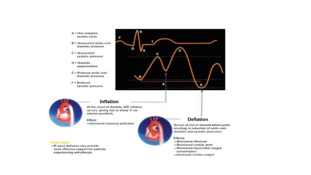 IABP troubleshooting | PPTX | Heart and Cardiovascular Diseases ...