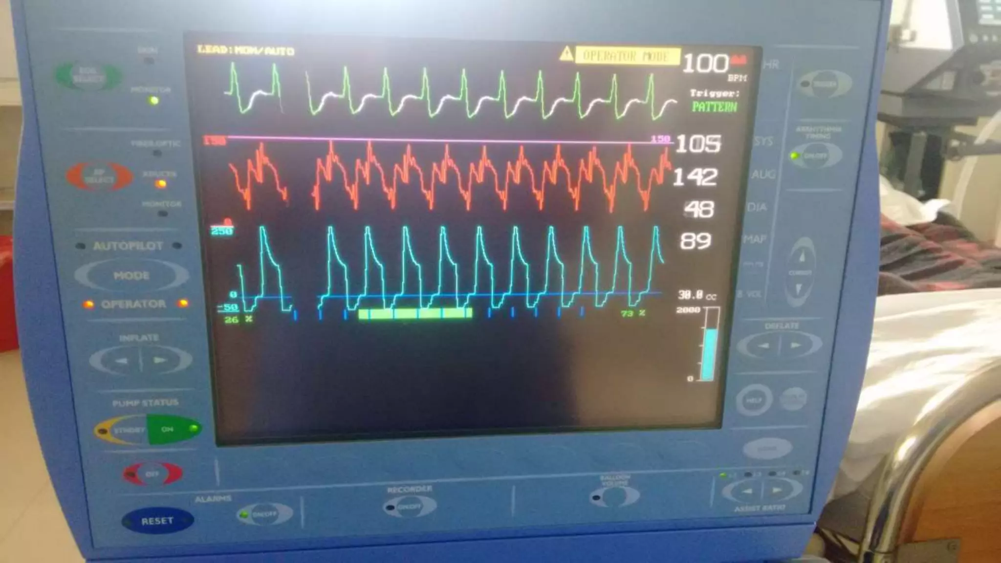 Iabp | PPTX