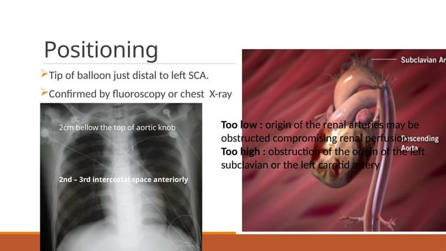 (IABP) Intra Aortic Baloon Pump review.pptx