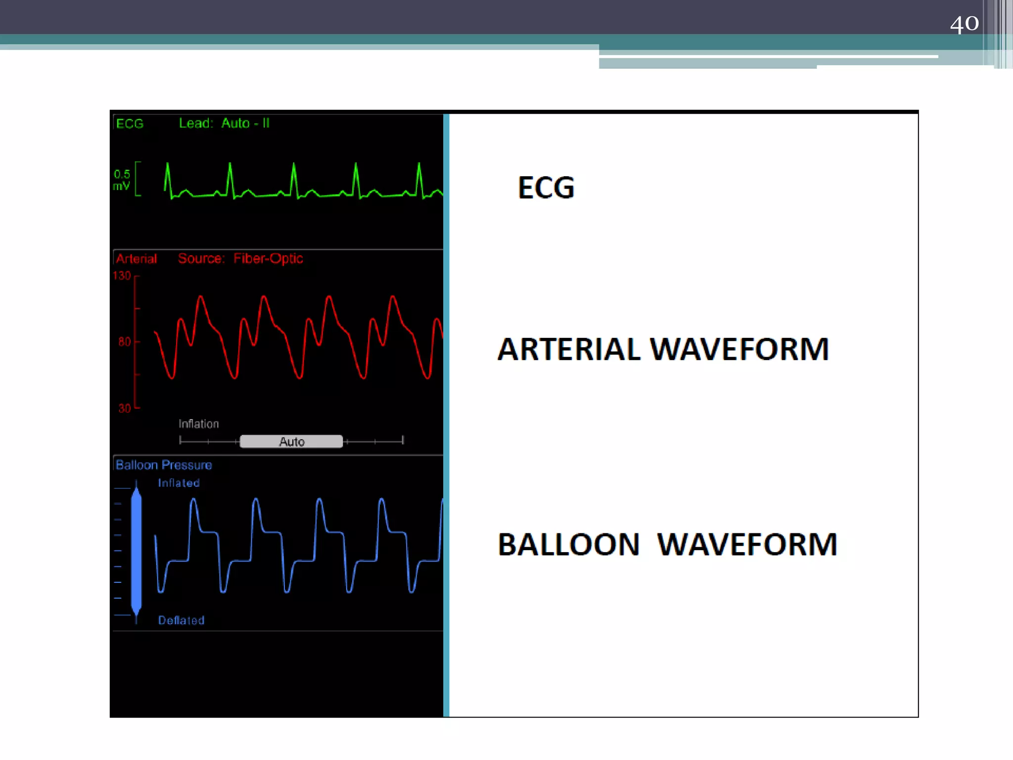 Iabp instrumentation, indications and complications | PPTX