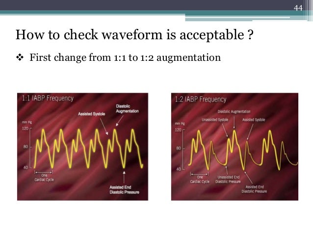 Iabp instrumentation, indications and complications