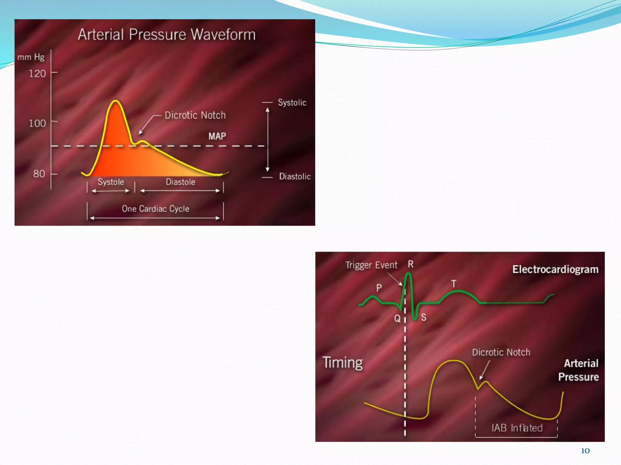 Iabp instrumentation, indications and complications | PPTX