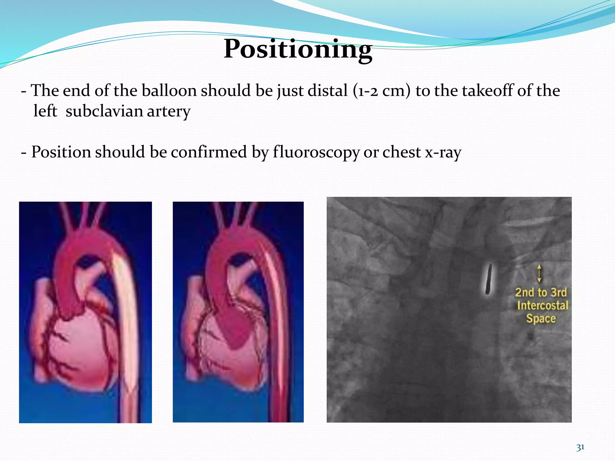 Iabp instrumentation, indications and complications | PPT