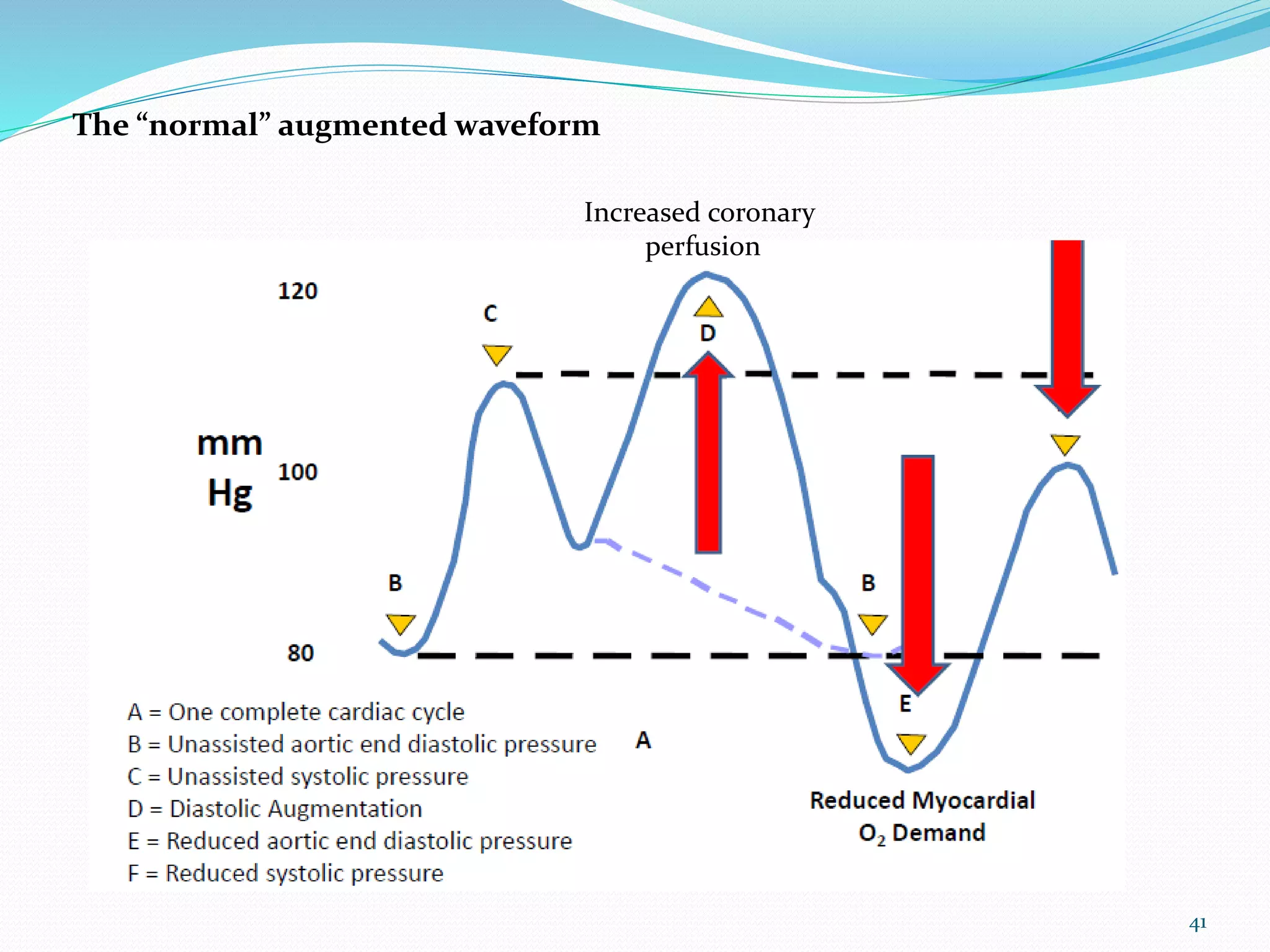 Iabp instrumentation, indications and complications | PPT