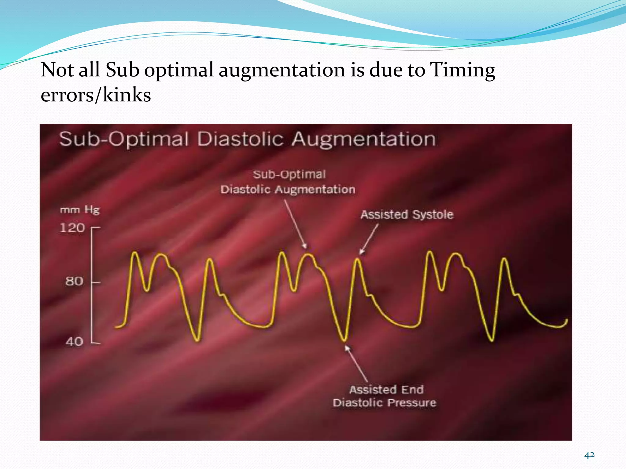Iabp instrumentation, indications and complications | PPT