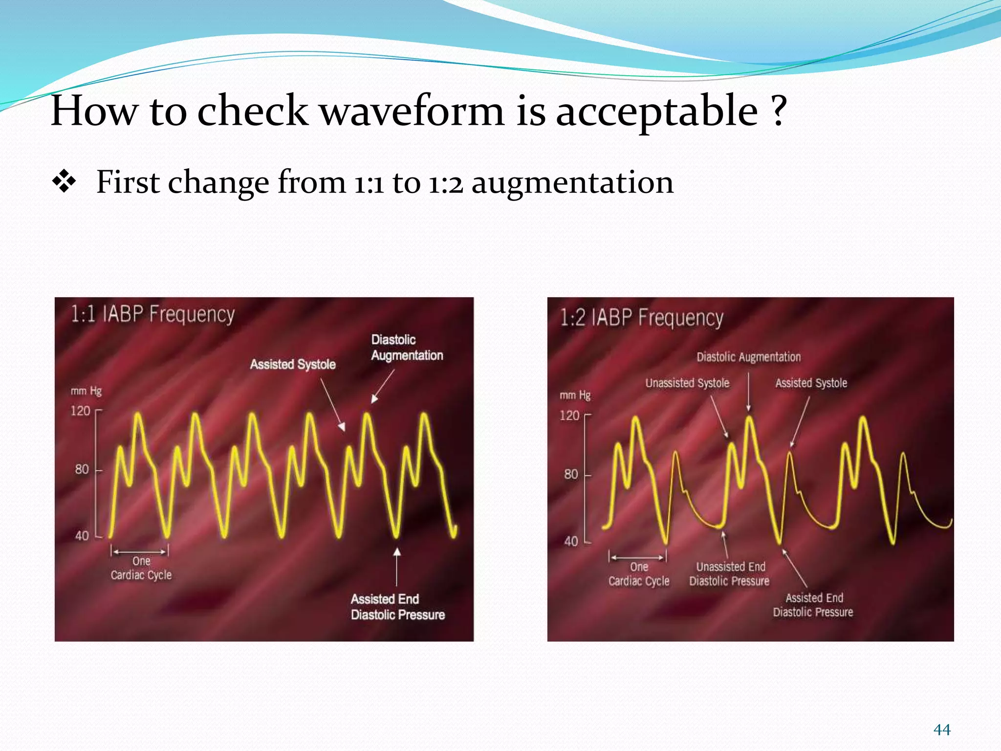 Iabp instrumentation, indications and complications | PPT