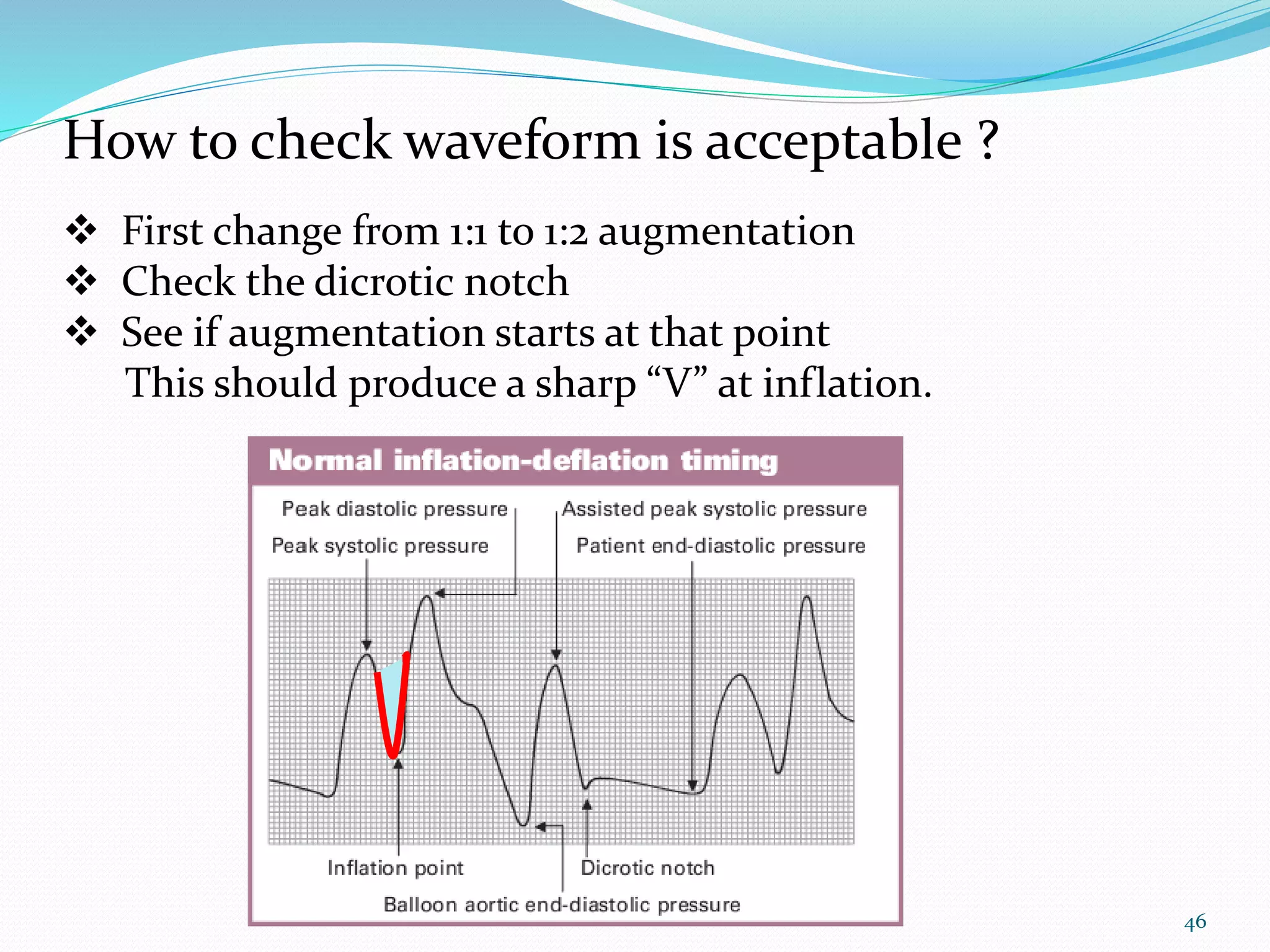 Iabp instrumentation, indications and complications | PPT
