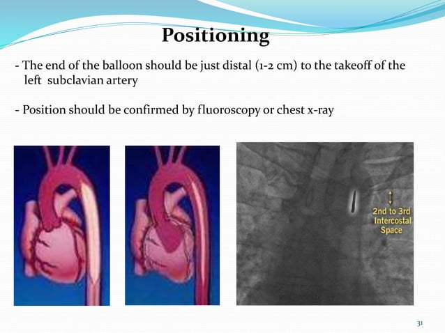 Iabp instrumentation, indications and complications | PPT