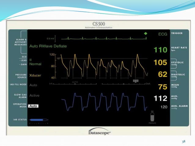 Iabp instrumentation, indications and complications | PPT