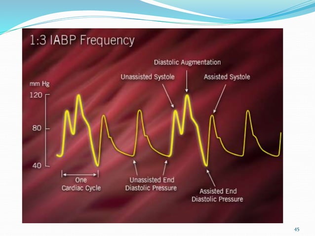 Iabp instrumentation, indications and complications | PPT