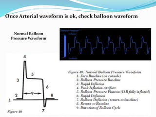 Iabp instrumentation, indications and complications | PPTX