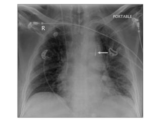 Intra Aortic Balloon Pump Xray