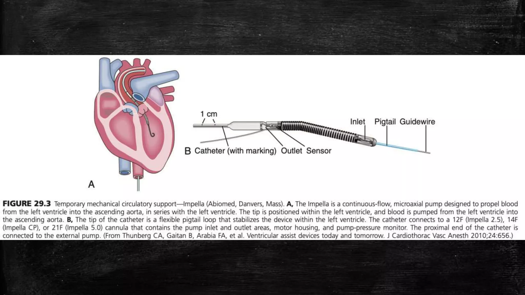Overview of Intra-Aortic Balloon Pump (IABP) | PPTX