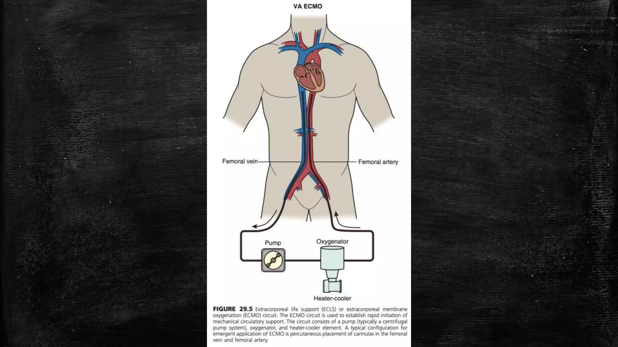 Overview of Intra-Aortic Balloon Pump (IABP) | PPTX