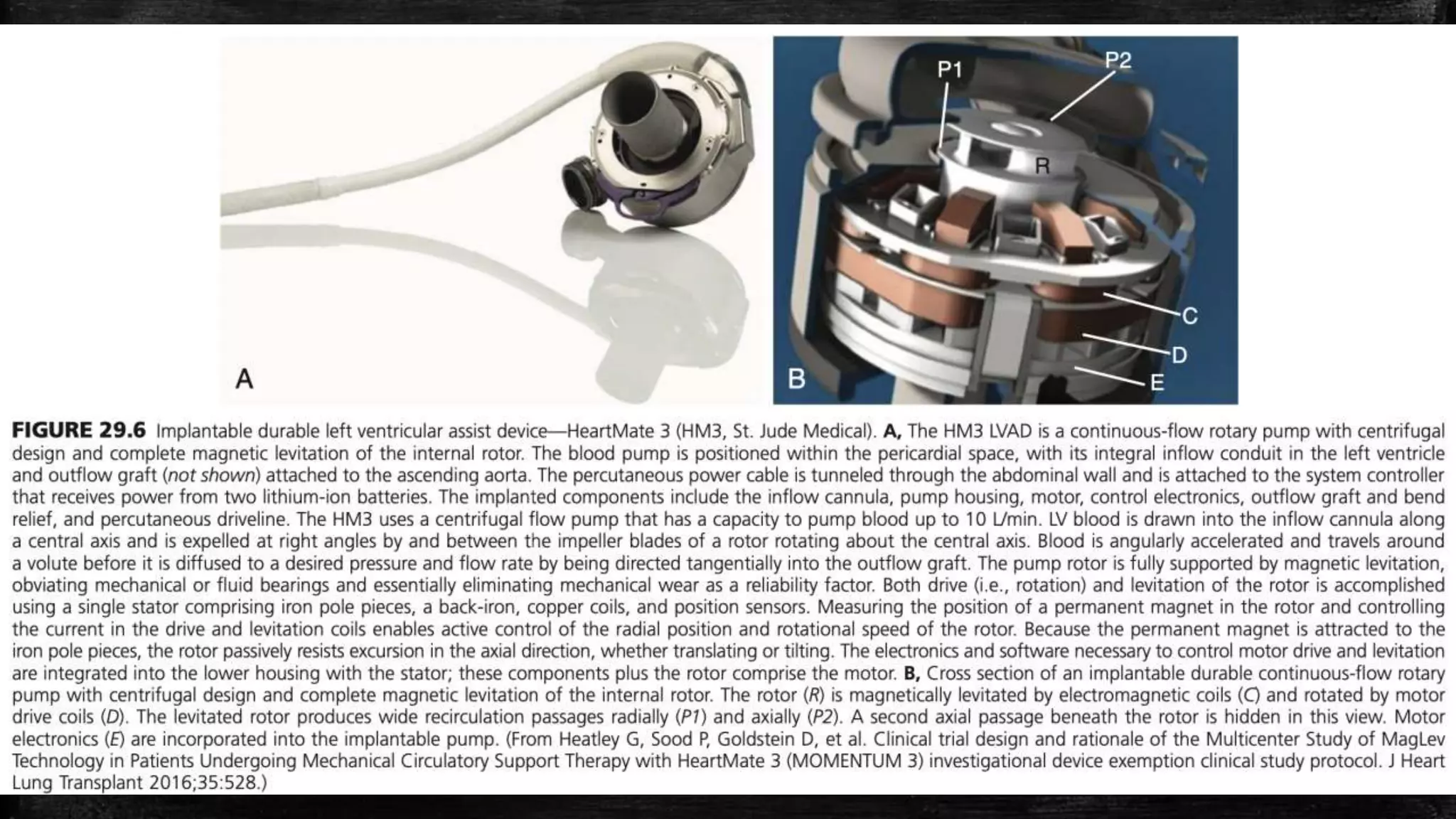 Overview of Intra-Aortic Balloon Pump (IABP) | PPTX