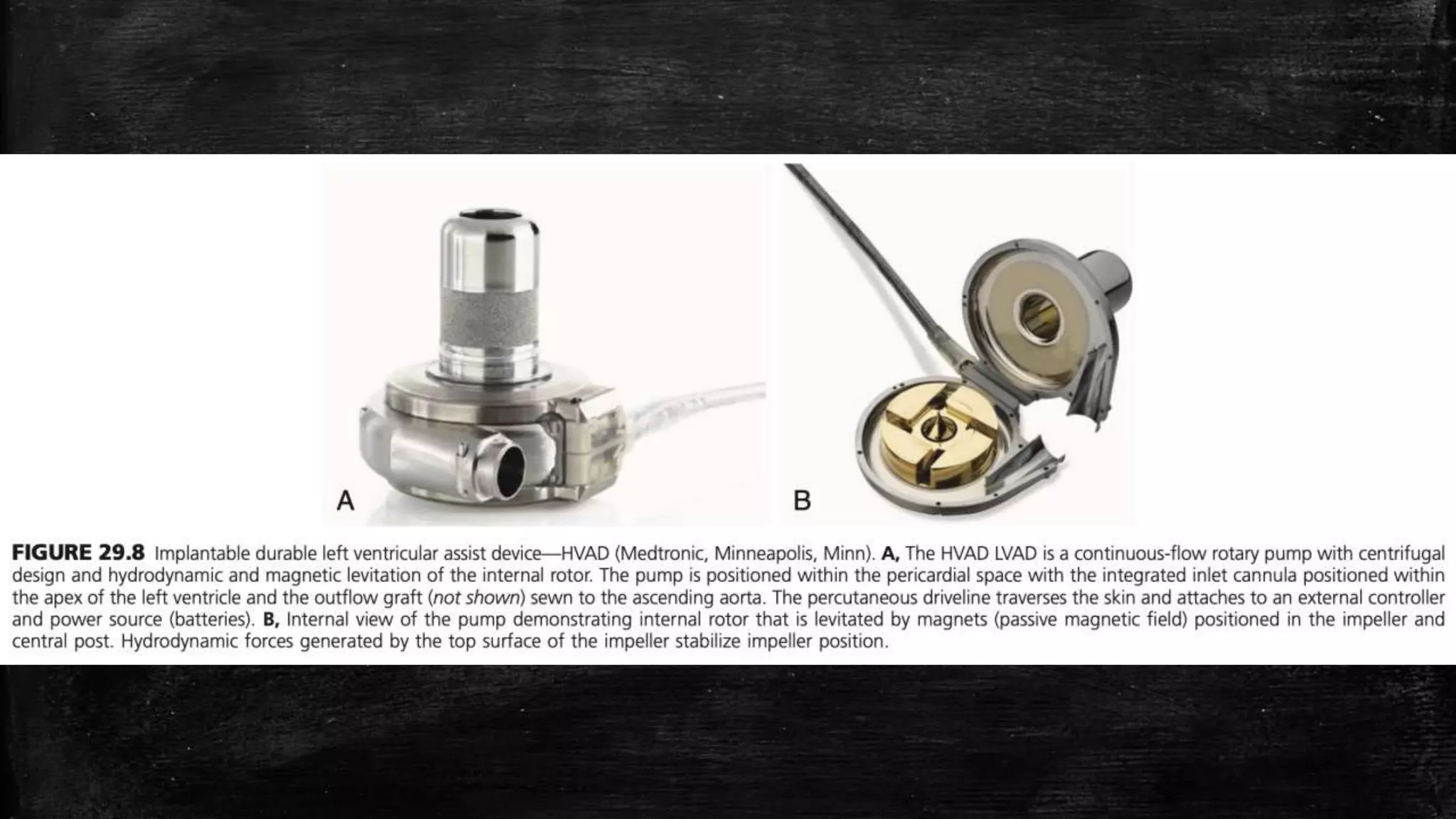 Overview of Intra-Aortic Balloon Pump (IABP) | PPTX