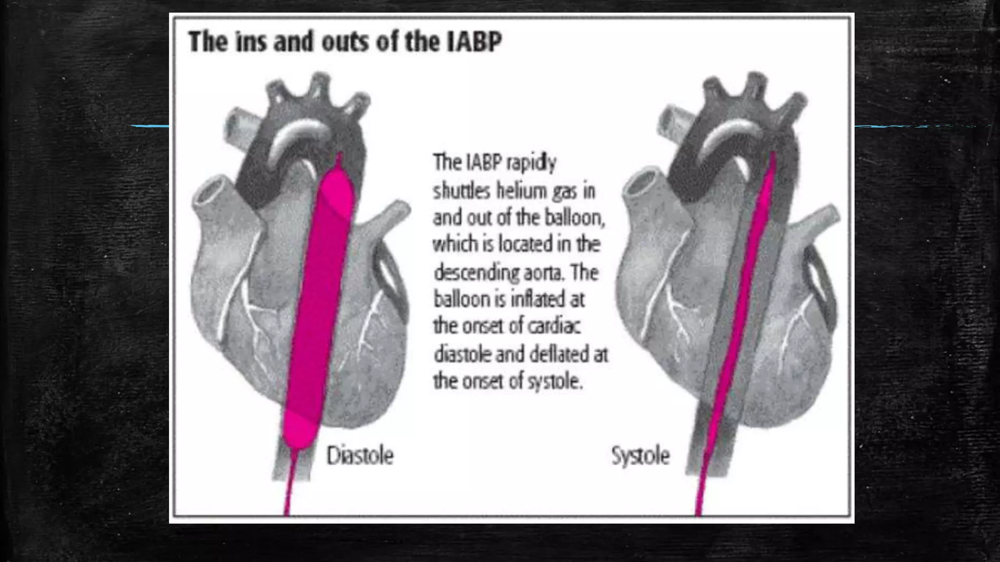 Overview of Intra-Aortic Balloon Pump (IABP) | PPTX