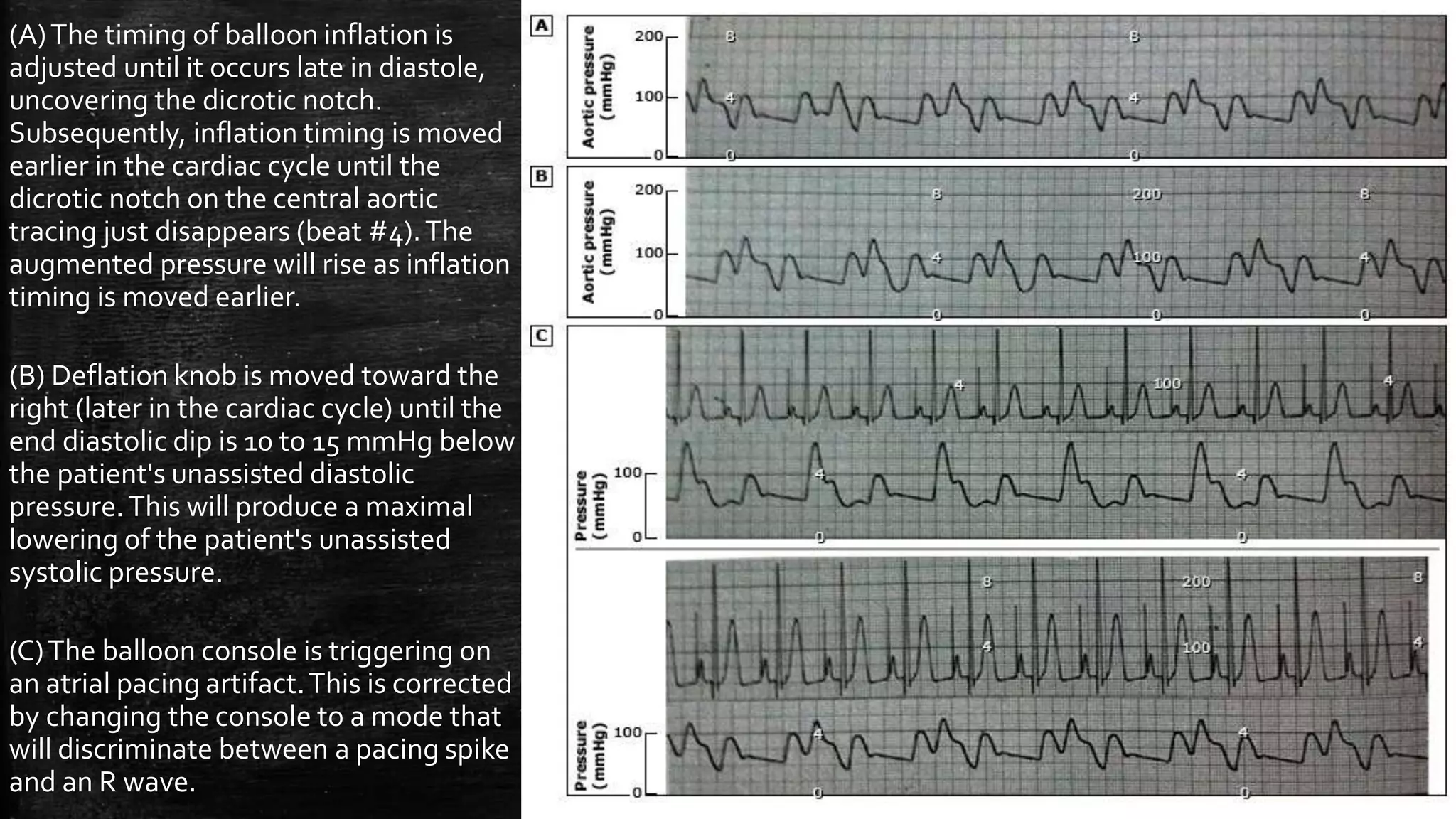 Overview of Intra-Aortic Balloon Pump (IABP) | PPTX