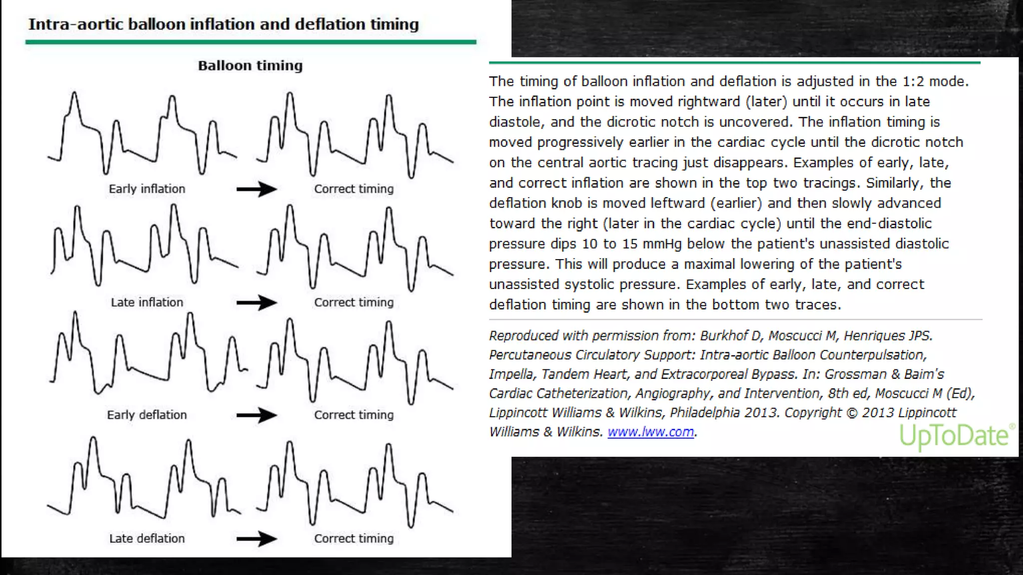 Overview of Intra-Aortic Balloon Pump (IABP) | PPTX