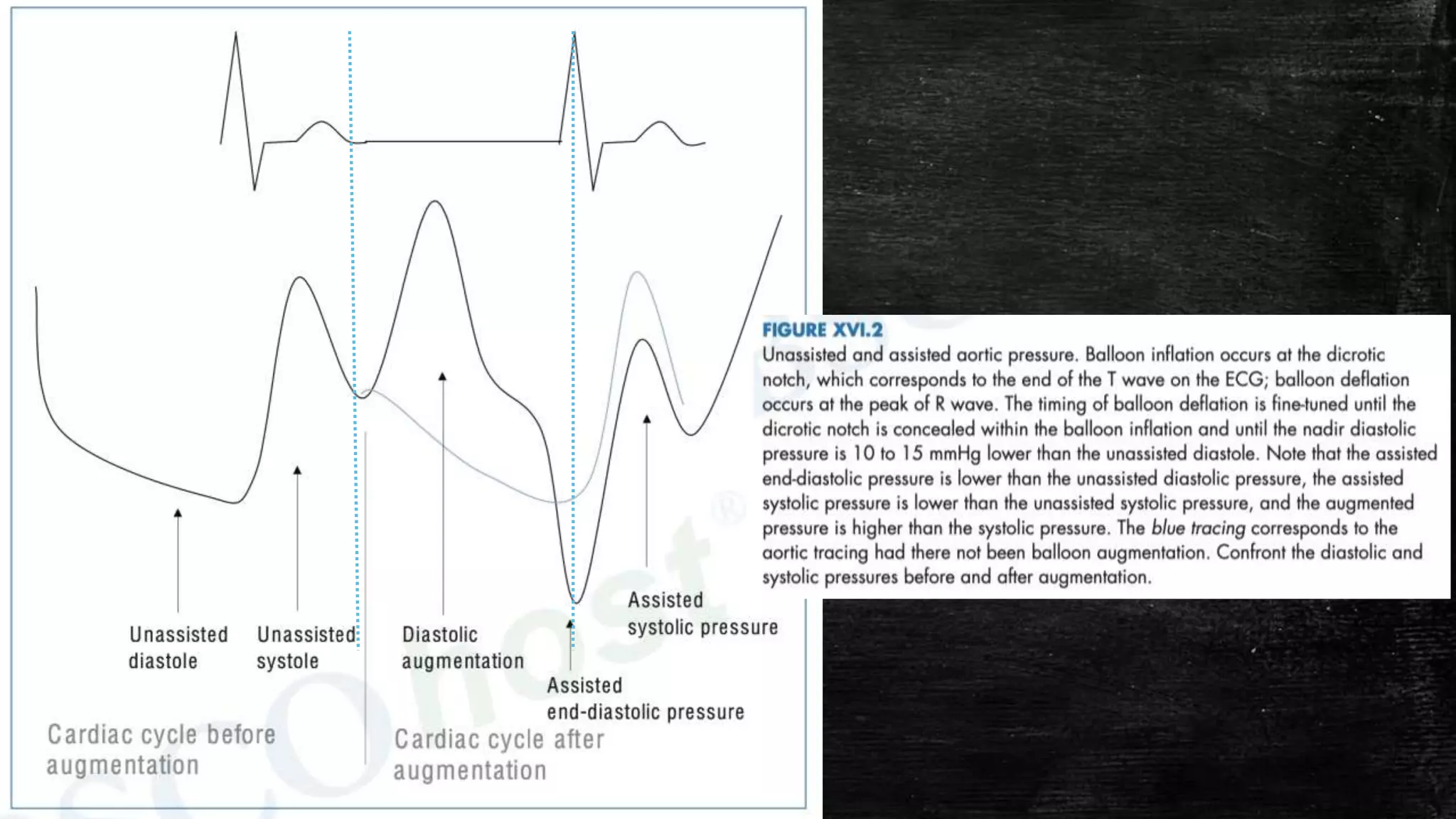 Overview of Intra-Aortic Balloon Pump (IABP) | PPTX
