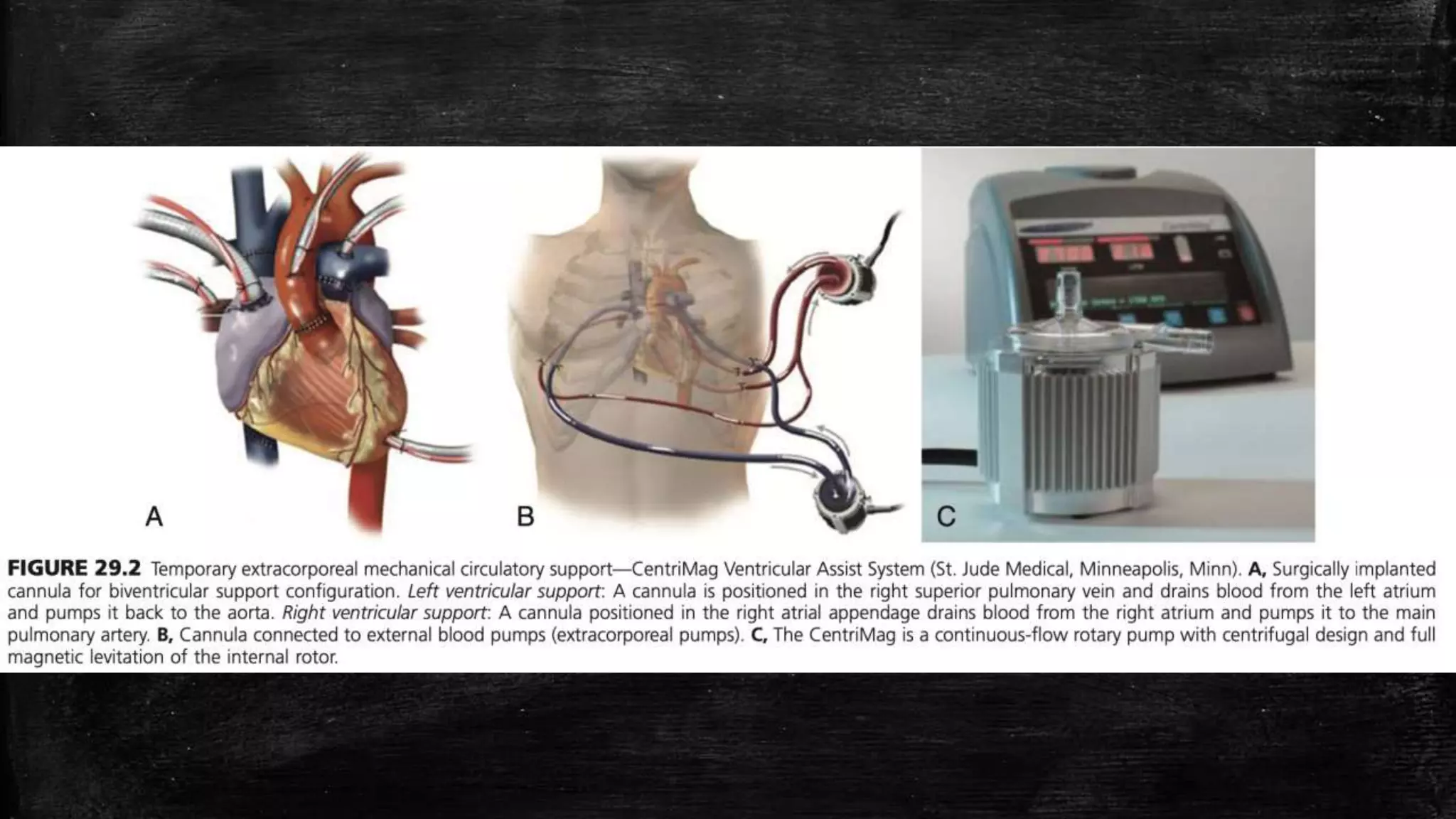 Overview of Intra-Aortic Balloon Pump (IABP) | PPTX