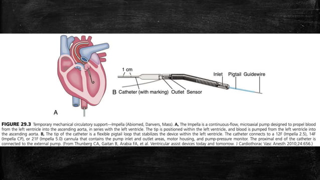 Overview of Intra-Aortic Balloon Pump (IABP) | PPTX | Heart and Cardiovascular Diseases ...