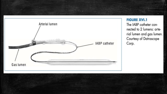 Overview of Intra-Aortic Balloon Pump (IABP) | PPTX | Heart and ...